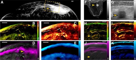 Multispectral Optoacoustic Tomography (MSOT) of Human Breast Cancer ...