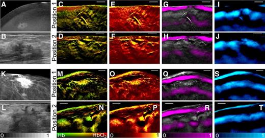 Multispectral Optoacoustic Tomography (MSOT) of Human Breast Cancer ...