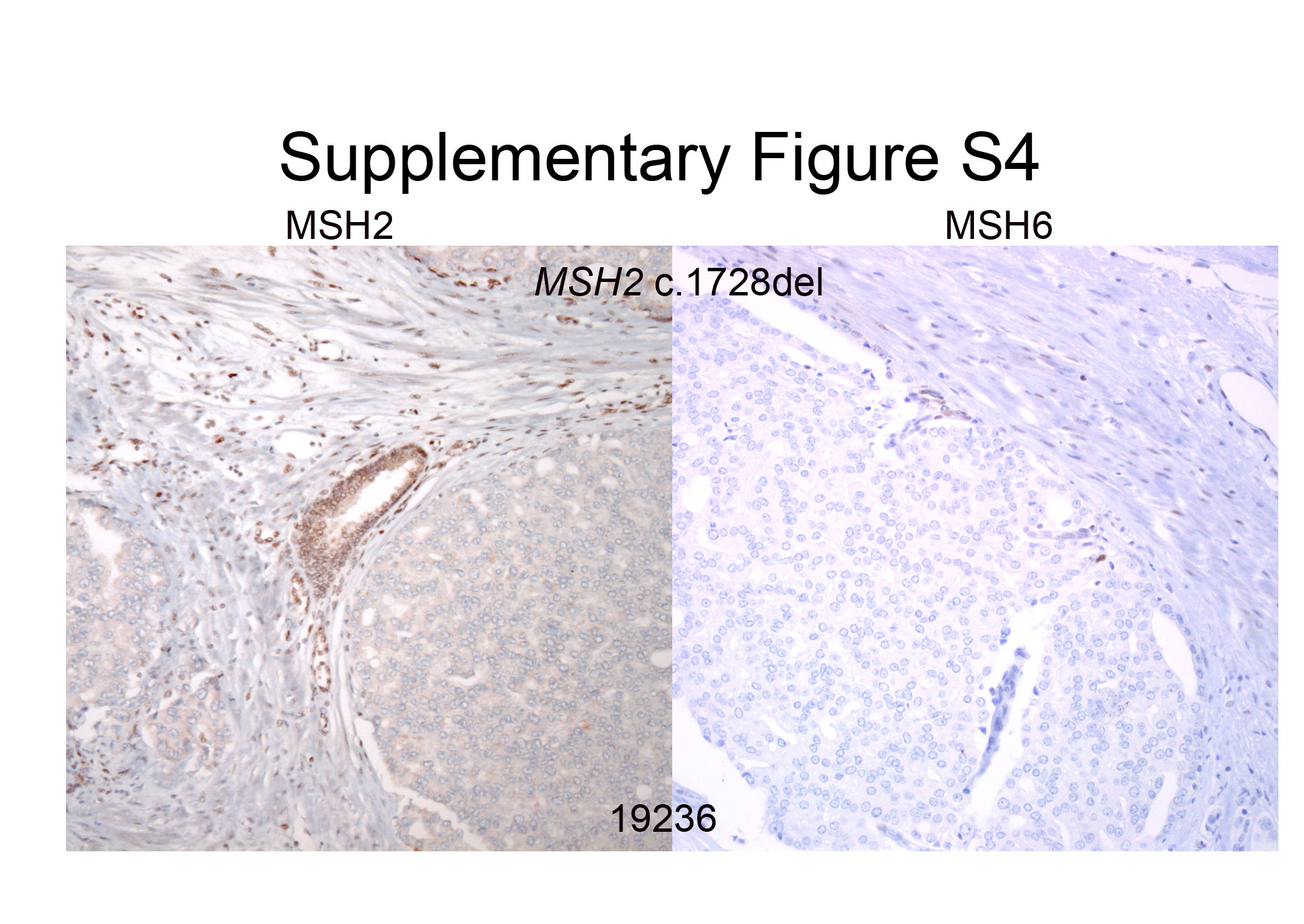 MSH2 Loss in Primary Prostate Cancer | Clinical Cancer Research ...