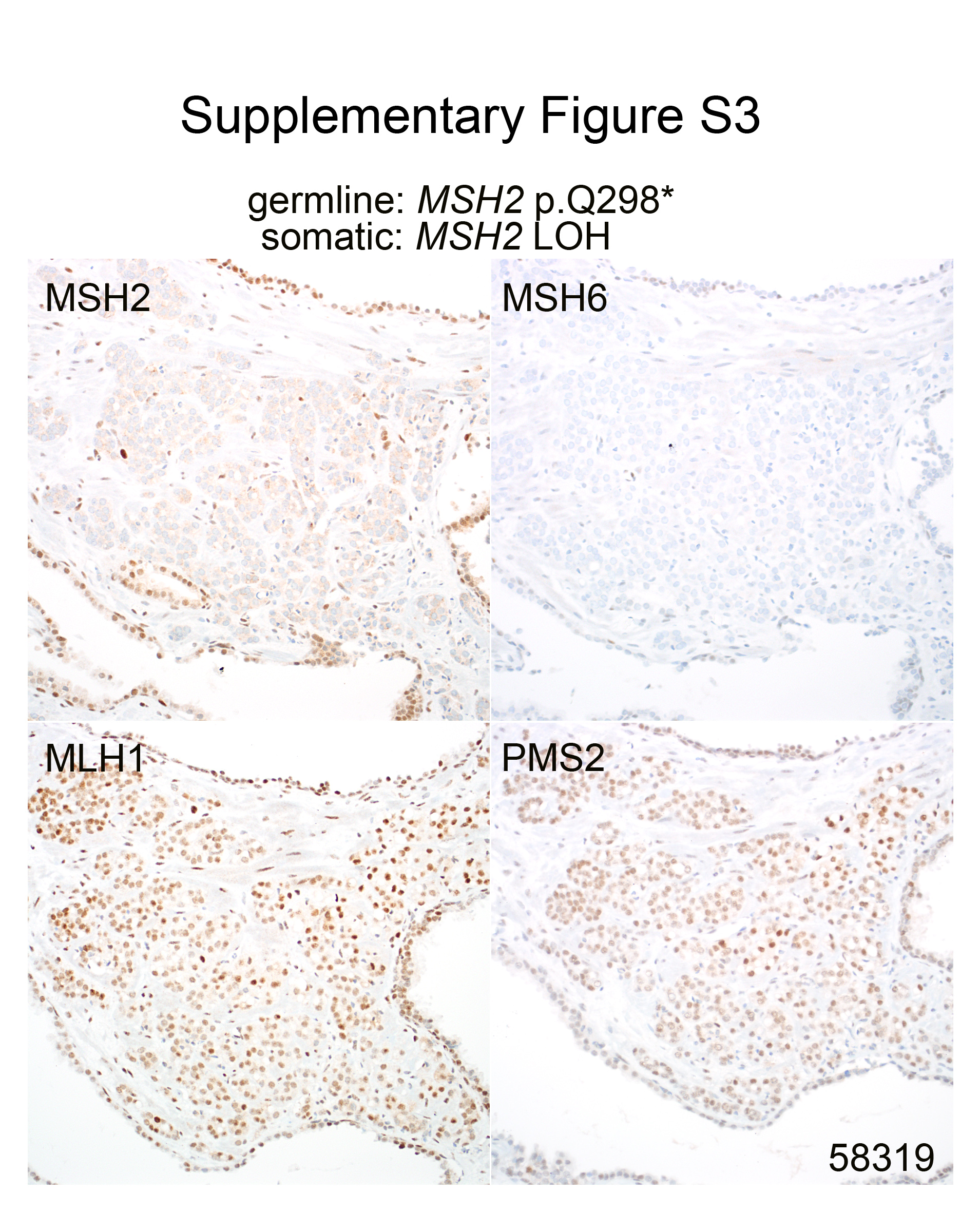MSH2 Loss in Primary Prostate Cancer | Clinical Cancer Research ...
