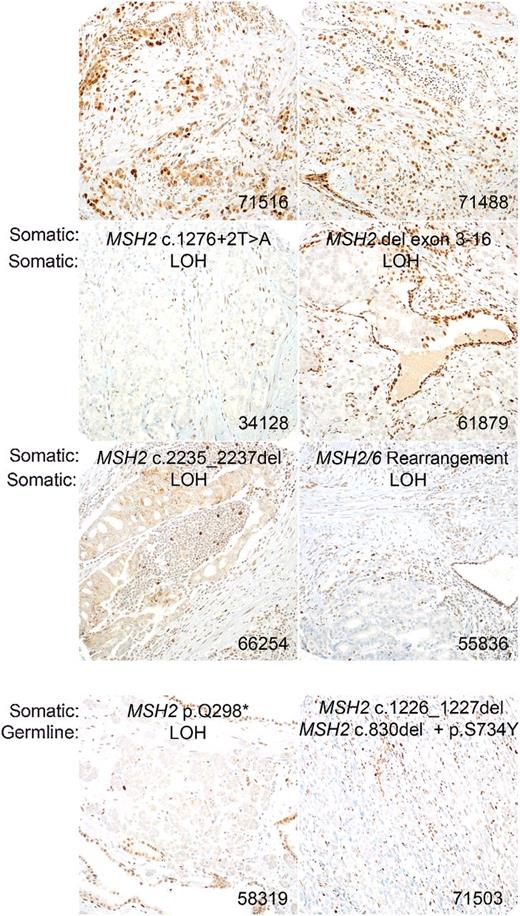 MSH2 Loss in Primary Prostate Cancer | Clinical Cancer Research ...
