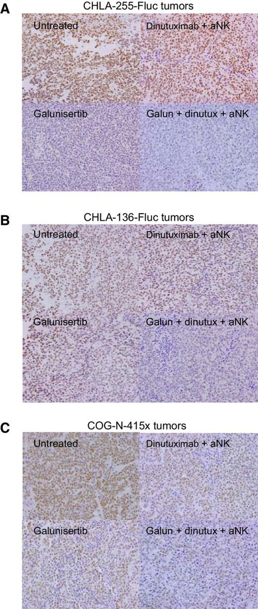 TGFβR1 Blockade with Galunisertib (LY2157299) Enhances Anti ...