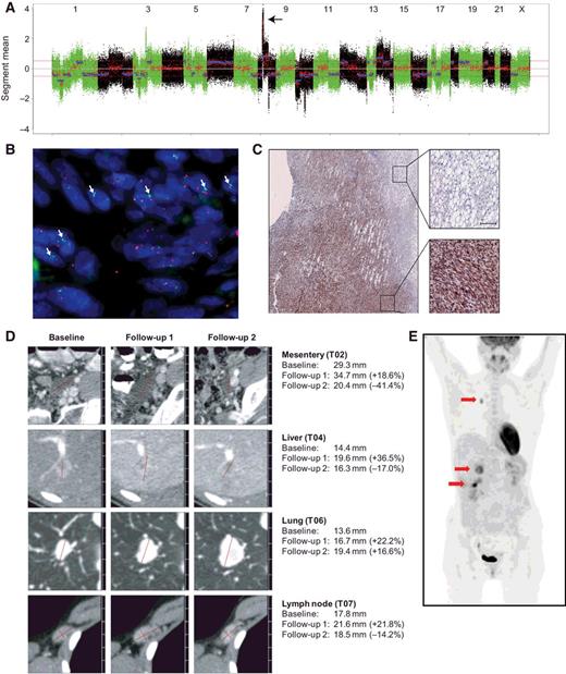 Targeting Fibroblast Growth Factor Receptor 1 for Treatment of Soft ...