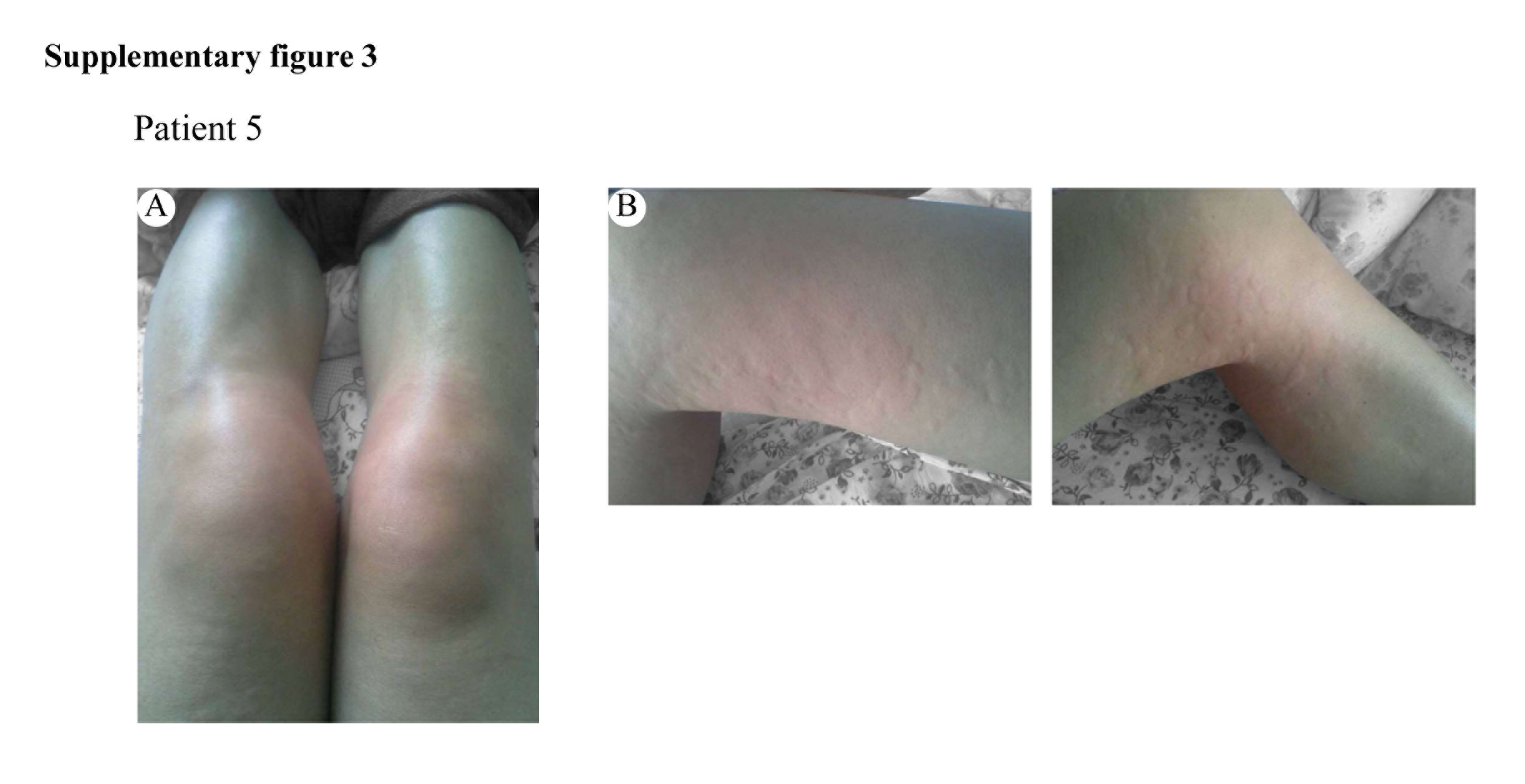 Autologous T Cells Expressing CD30 Chimeric Antigen Receptors for ...