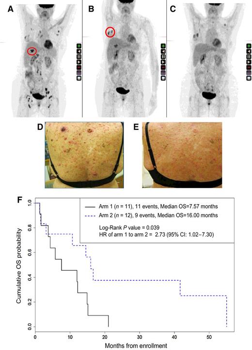 Focal Irradiation and Systemic TGFβ Blockade in Metastatic Breast ...