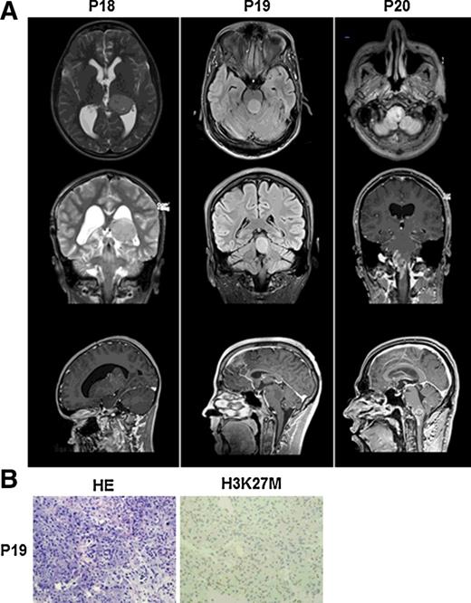 Molecular Diagnosis of Diffuse Gliomas through Sequencing of Cell-Free ...