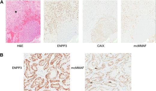 Phase I Trials of Anti-ENPP3 Antibody–Drug Conjugates in Advanced ...