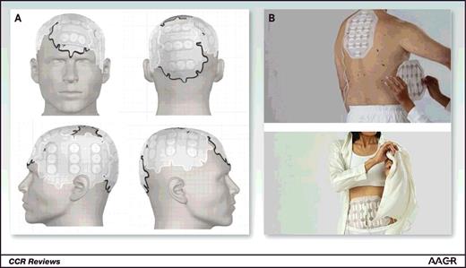 Tumor-Treating Fields: A Fourth Modality in Cancer Treatment | Clinical ...