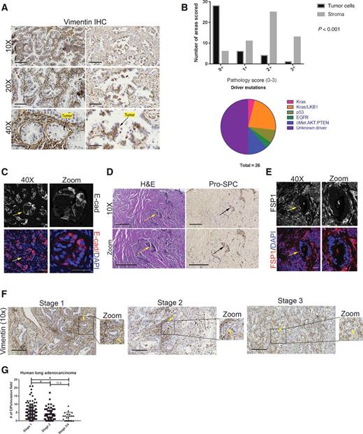 Vimentin Is Required for Lung Adenocarcinoma Metastasis via Heterotypic ...