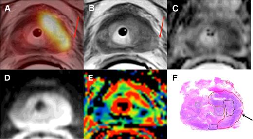 PSMA Ligand PET/MRI for Primary Prostate Cancer: Staging Performance ...