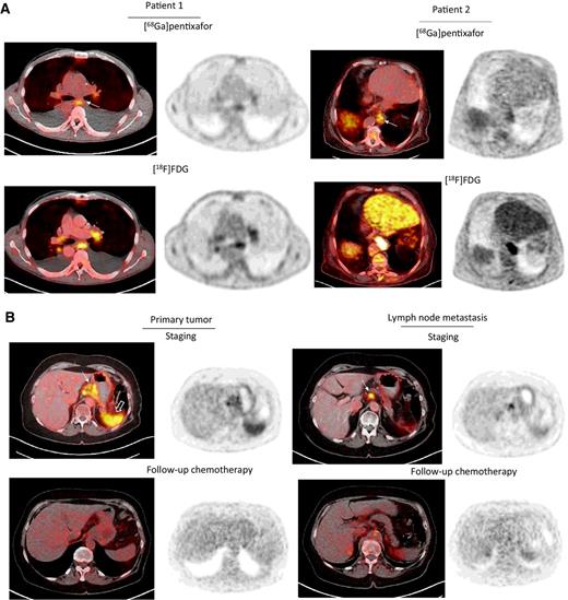 CXCR4 Is a Potential Target for Diagnostic PET/CT Imaging in Barrett's ...