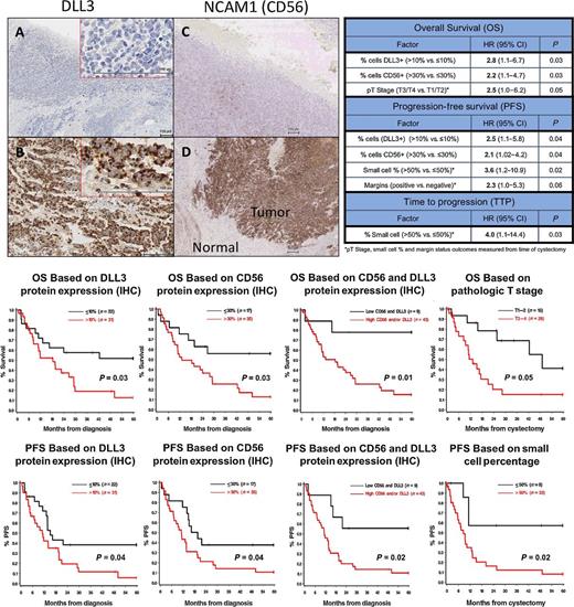 Transcriptomic and Protein Analysis of Small-cell Bladder Cancer (SCBC ...