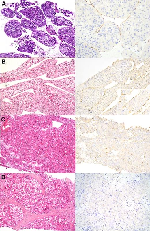 ESM1 as a Marker of Macrotrabecular-Massive Hepatocellular Carcinoma ...