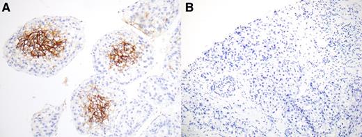 ESM1 as a Marker of Macrotrabecular-Massive Hepatocellular Carcinoma ...