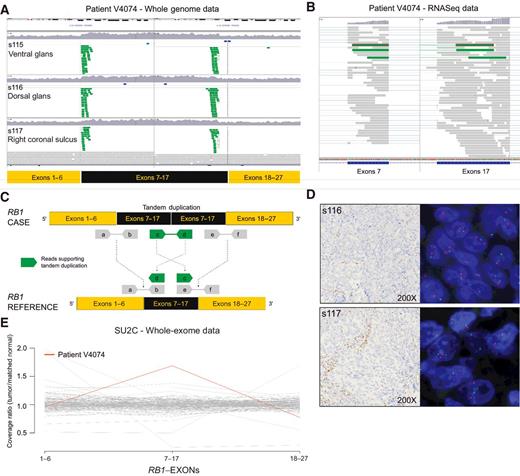 RB1 Heterogeneity in Advanced Metastatic Castration-Resistant Prostate ...