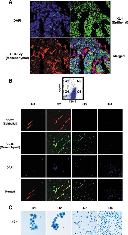 CD45+CD326+ Cells are Predictive of Poor Prognosis in Non–Small Cell ...