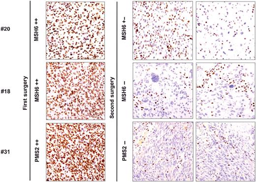 Genetic, Epigenetic, and Immunologic Profiling of MMR-Deficient ...