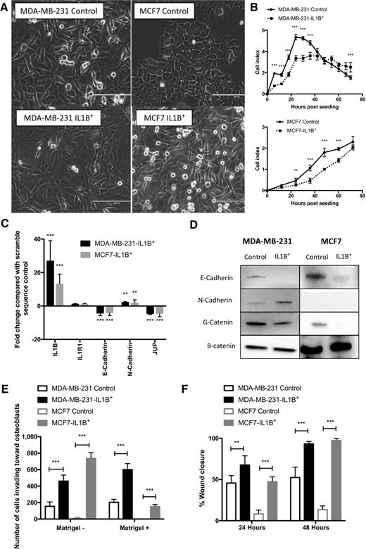 Endogenous Production of IL1B by Breast Cancer Cells Drives Metastasis ...