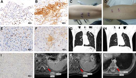 Genomic and Immunologic Characterization of INI1-Deficient Pediatric ...