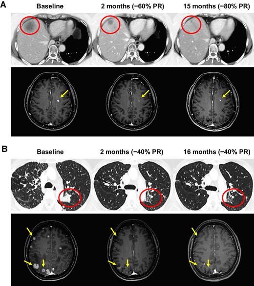 Repotrectinib Exhibits Potent Antitumor Activity in Treatment-Naïve and ...
