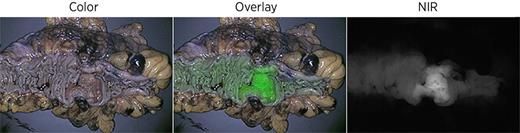 First-in-Human Assessment of cRGD-ZW800-1, a Zwitterionic, Integrin ...