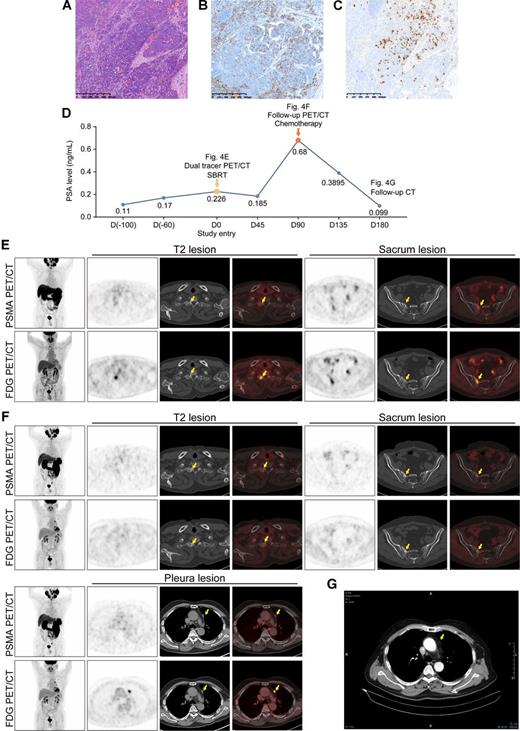 A Prospective Trial of 68Ga-PSMA and 18F-FDG PET/CT in Nonmetastatic ...