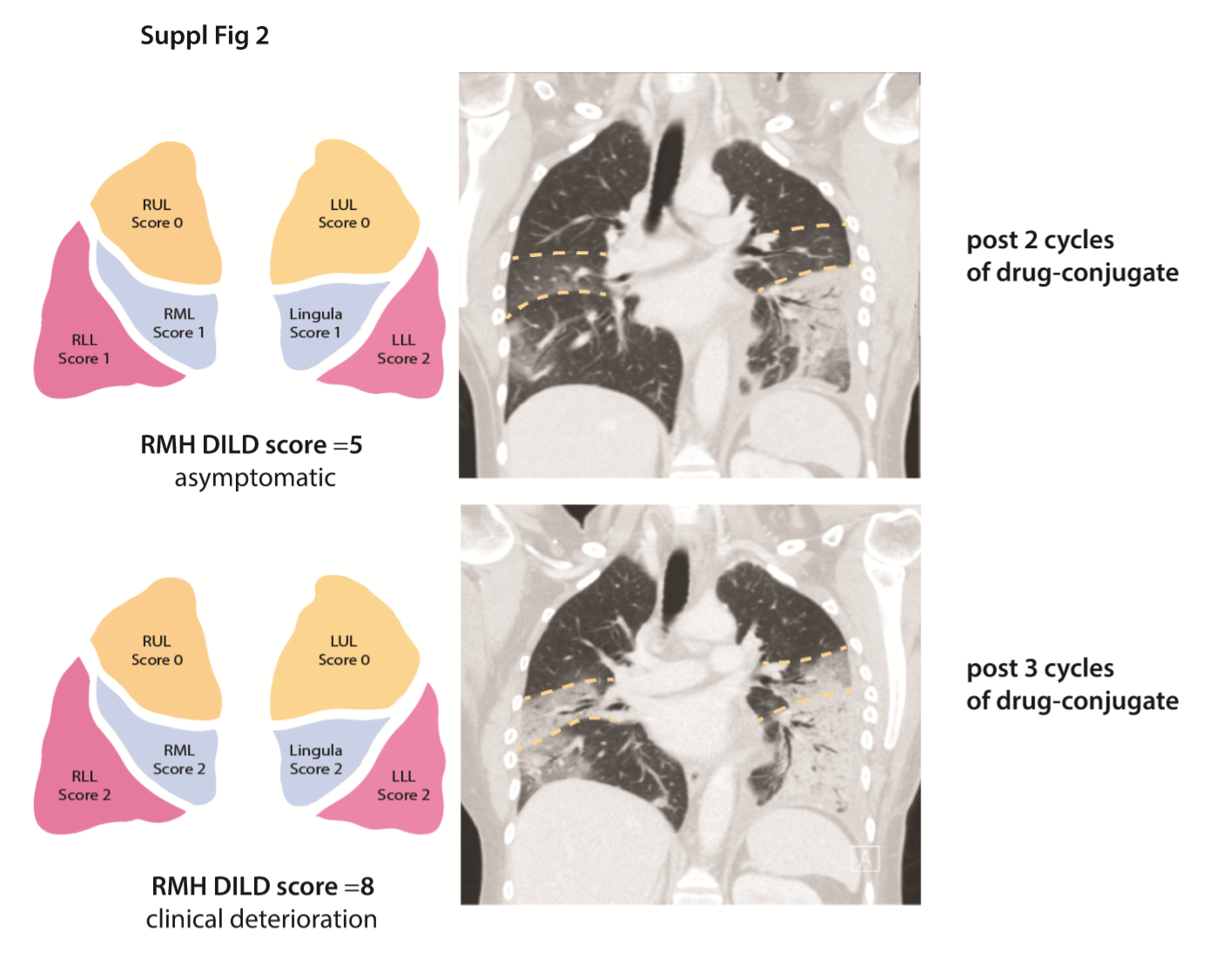 Radiological Patterns of Drug-induced Interstitial Lung Disease (DILD ...
