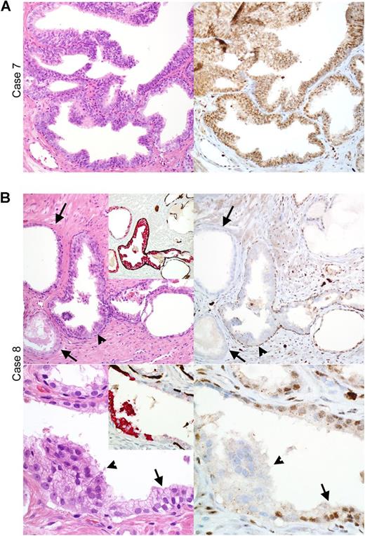 Genomic and Clinicopathologic Characterization of ATM-deficient ...