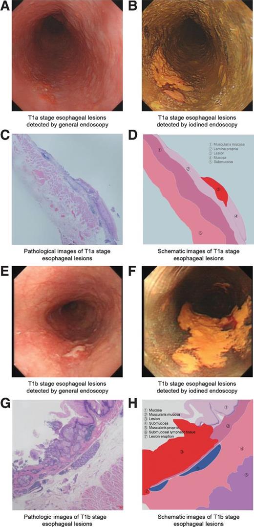 Submucosal Saline Injection Followed by Endoscopic Ultrasound versus ...