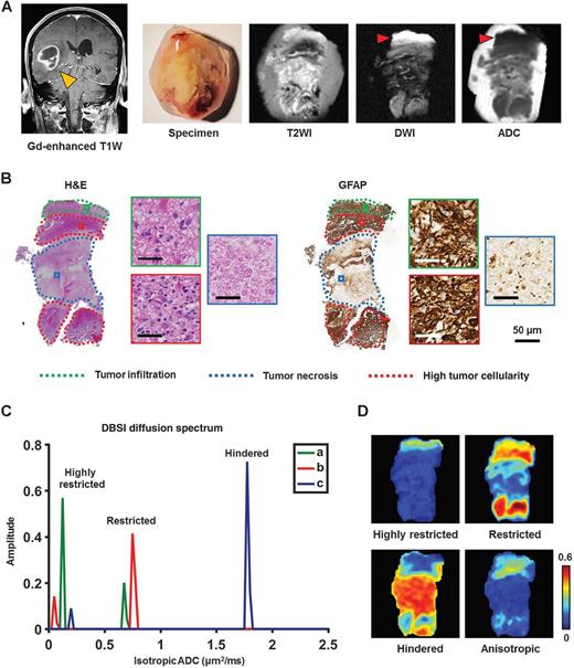 Diffusion Histology Imaging Combining Diffusion Basis Spectrum Imaging ...