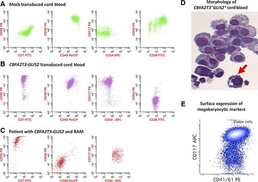 Comprehensive Transcriptome Profiling of Cryptic CBFA2T3–GLIS2 Fusion ...
