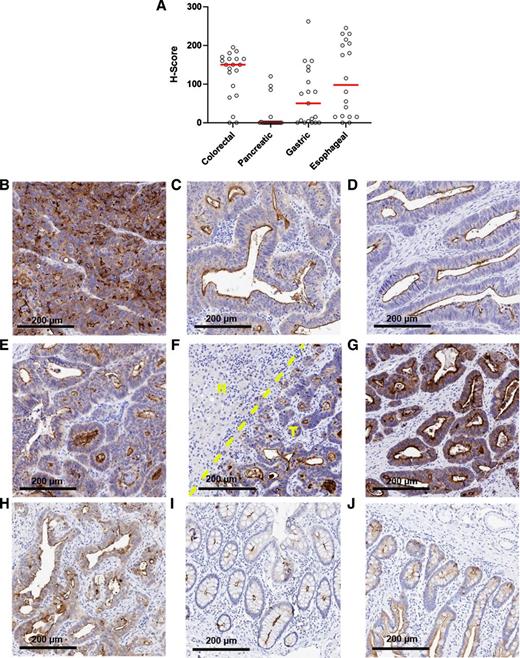 A Novel GUCY2C-CD3 T-Cell Engaging Bispecific Construct (PF-07062119 ...