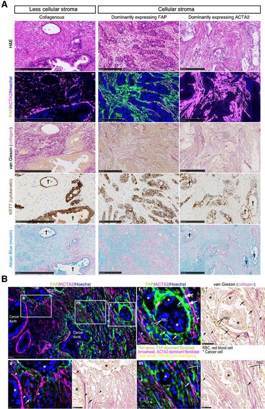 Three Distinct Stroma Types in Human Pancreatic Cancer Identified by ...