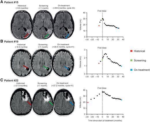 Vorasidenib, a Dual Inhibitor of Mutant IDH1/2, in Recurrent or ...