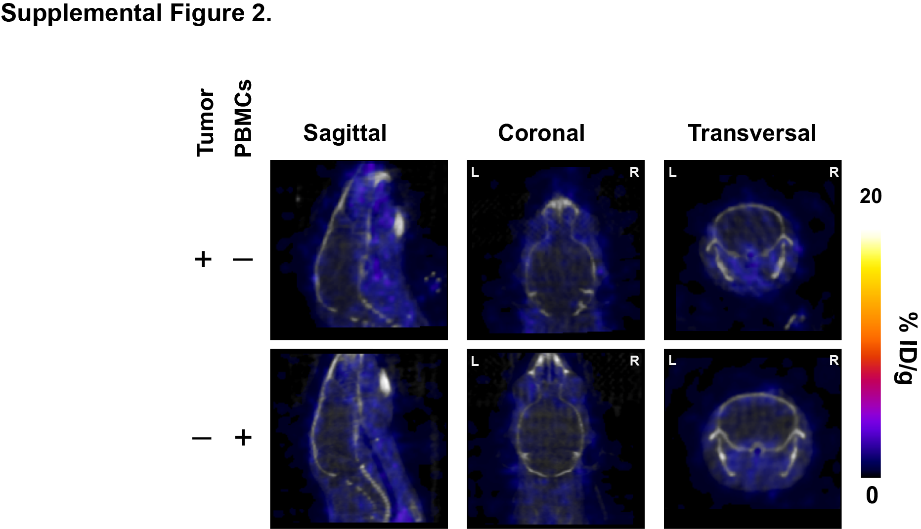 Imaging Tumor-Infiltrating Lymphocytes in Brain Tumors with [64Cu]Cu ...