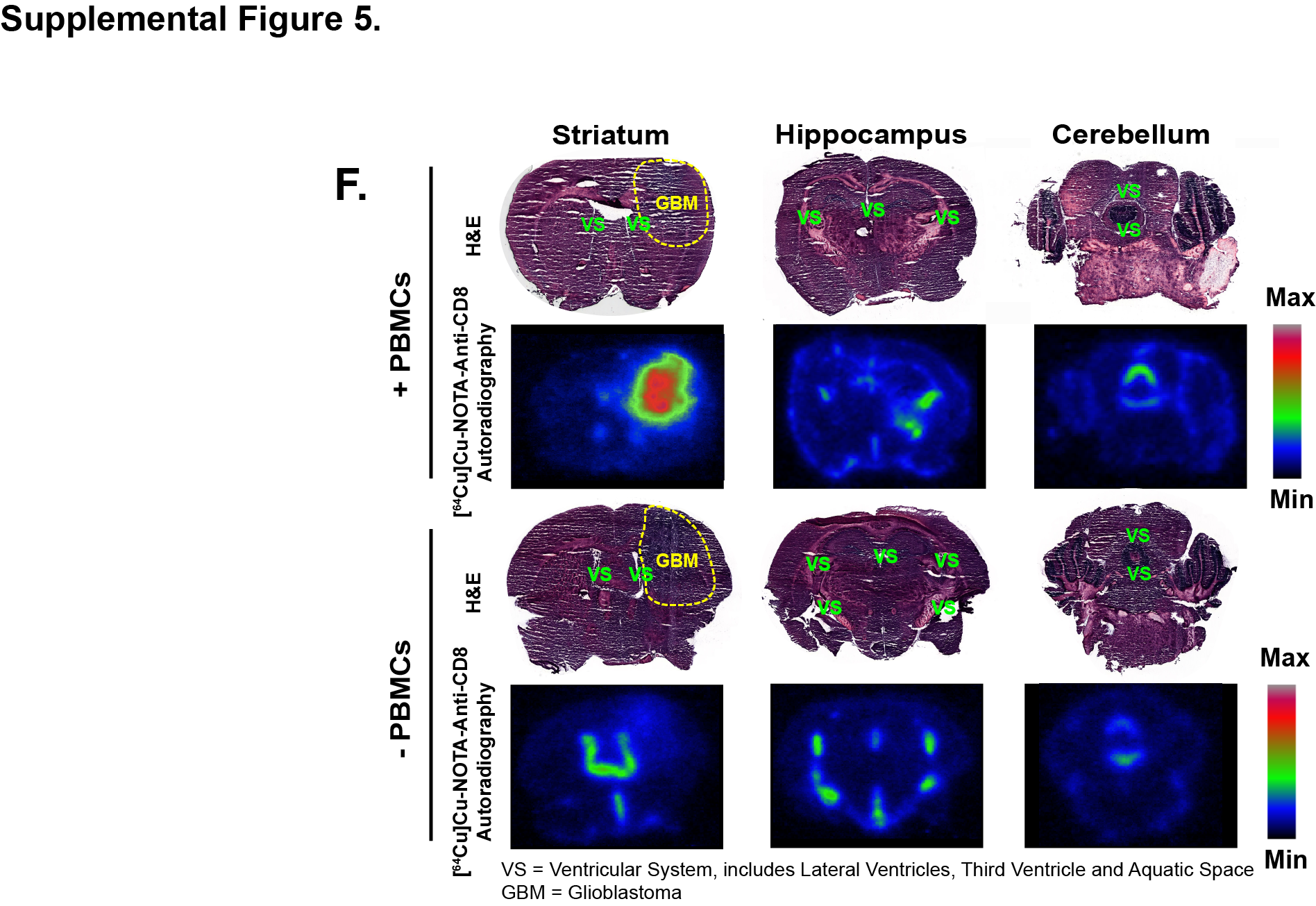 Imaging Tumor-Infiltrating Lymphocytes in Brain Tumors with [64Cu]Cu ...