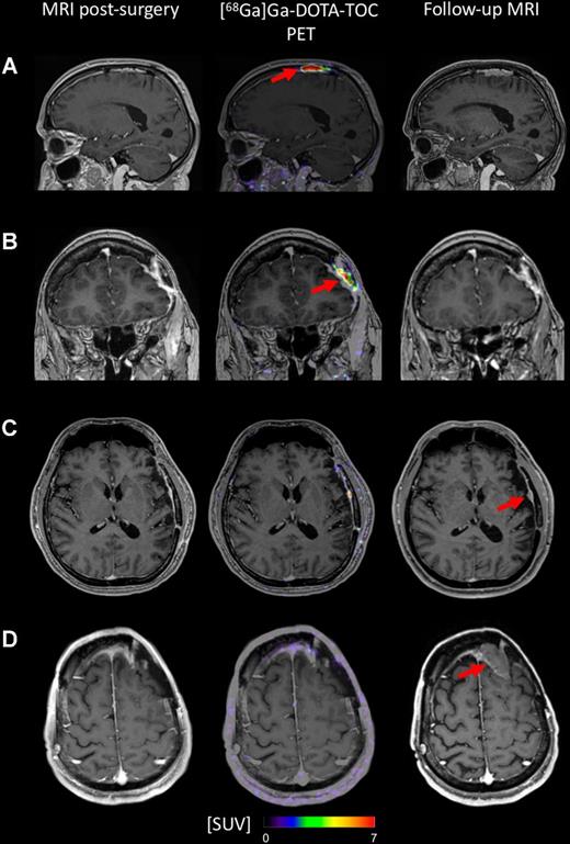 Improved Detection of Postoperative Residual Meningioma with [68Ga]Ga ...