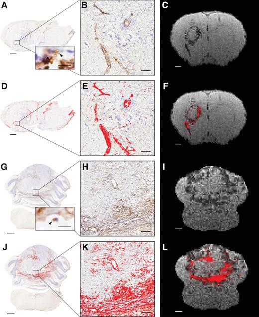 Vcam 1 Targeted Mri Improves Detection Of The Tumor Brain Interface Clinical Cancer Research