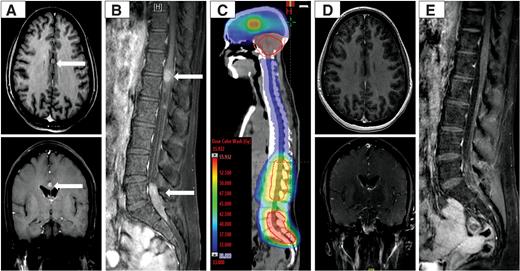 Omission of Upfront Craniospinal Irradiation in Patients with Low-Risk ...