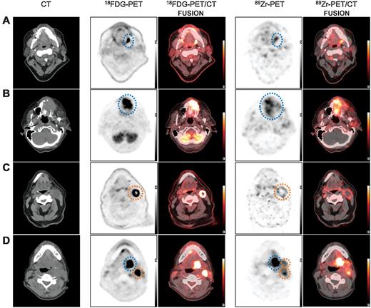 89Zr-panitumumab Combined With 18F-FDG PET Improves Detection and ...