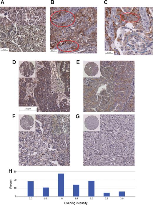 Bevacizumab May Differentially Improve Prognosis of Advanced Ovarian ...
