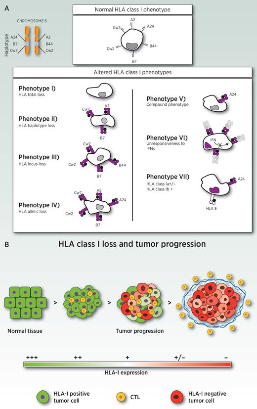 The Challenges of HLA Class I Loss in Cancer Immunotherapy: Facts and ...