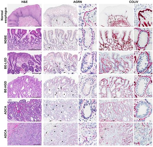 Agrin Loss in Barrett's Esophagus-Related Neoplasia and Its Utility as ...