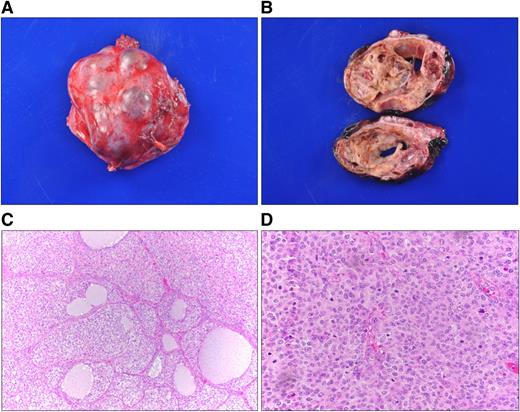 Integrated Analysis of Ovarian Juvenile Granulosa Cell Tumors Reveals ...