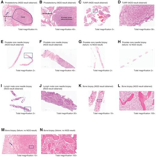 Tumor Genomic Testing for >4,000 Men with Metastatic Castration ...