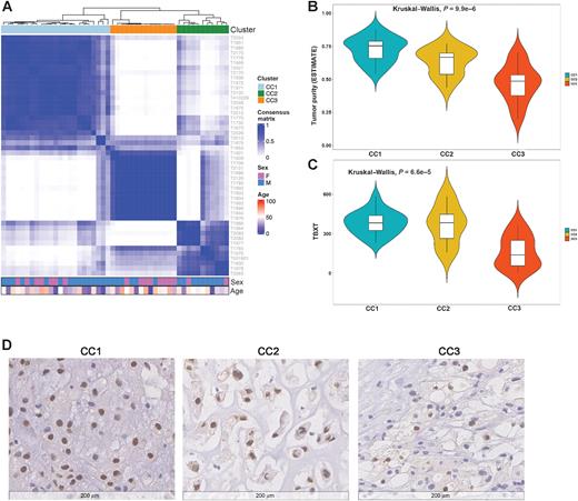 Gene Expression Profiling Identifies Two Chordoma Subtypes Associated ...