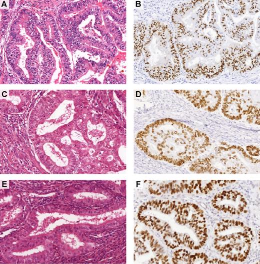 Clinical Behavior and Molecular Landscape of Stage I p53-Abnormal Low ...
