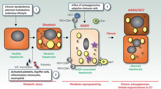 NASH and Hepatocellular Carcinoma: Immunology and Immunotherapy ...