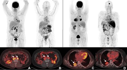 [89Zr]Zr-DFO-girentuximab and [18F]FDG PET/CT to Predict Watchful ...