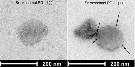 Circulating Exosomal PD-L1 at Initial Diagnosis Predicts Outcome and ...